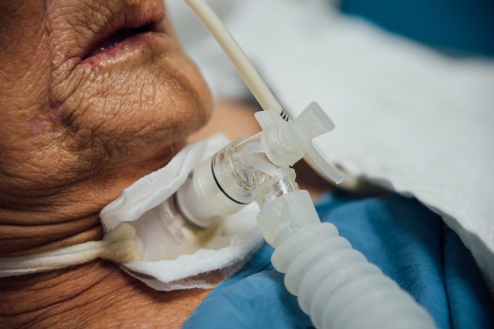 Understanding Tracheostomy Complications and Prevention
